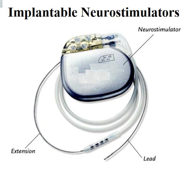 Implantable Neurostimulator Market SWOT Analysis by Key Players ...
