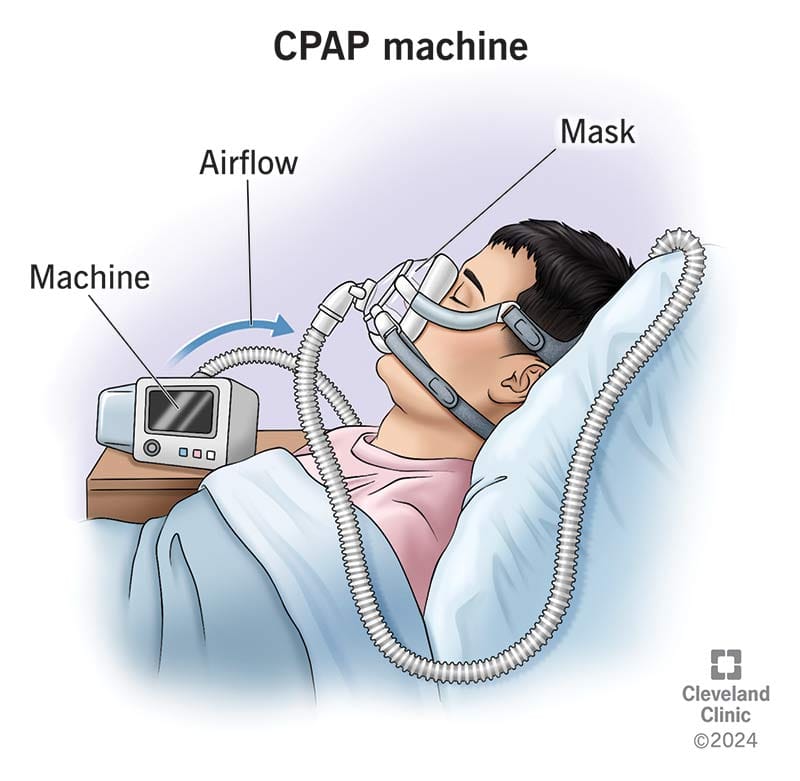 CPAP Device Market May See Big Move | Fosun Pharma , Teijin Pharma ...