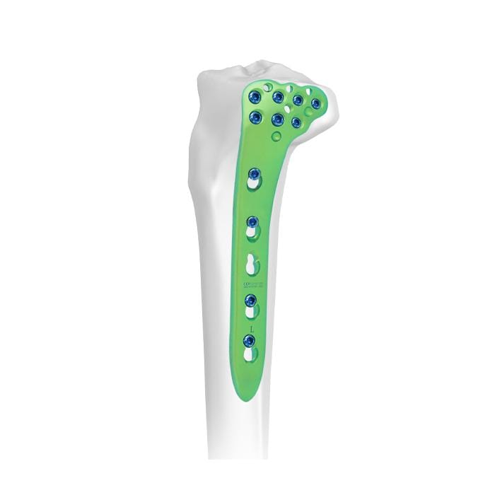 Locking Plate System Market to Witness Stunning Growth with Synthes ...