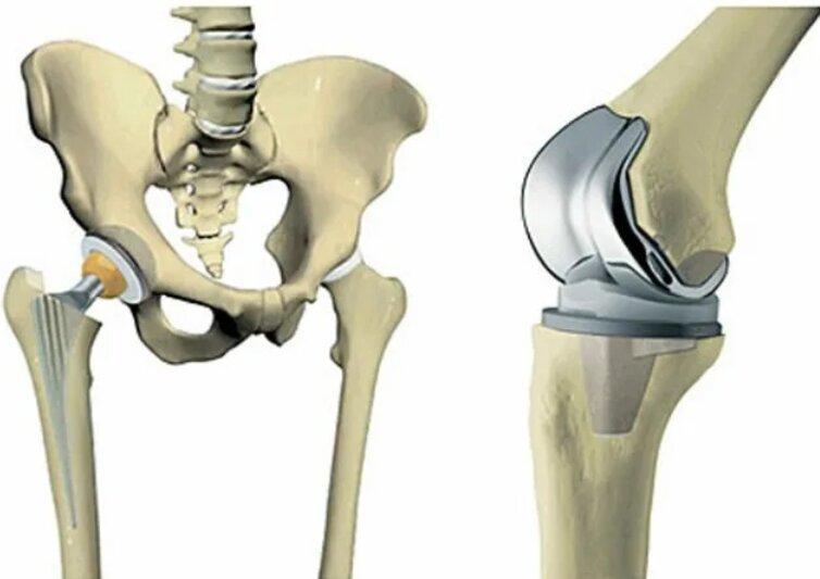 Hip Reconstruction Devices Market: Regaining Its Glory | Exactech ...