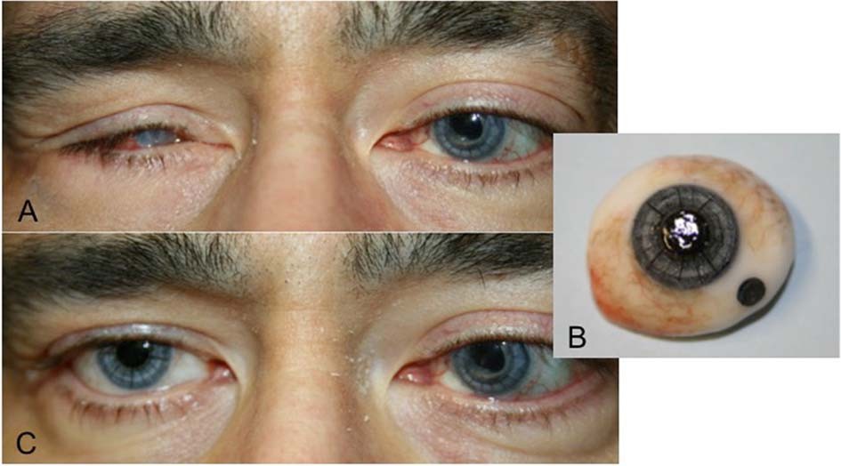 Ocular Prosthesis Market to See Massive Growth by 2031 | OrthoSensor ...