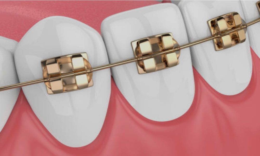 Archwire Market Review: All Eyes on 2024 Outlook - Newstrail