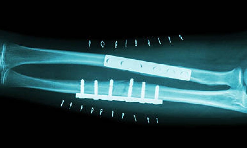 Bone Plating System Market Growth | Advanced Orthopedic Surgical Solutions