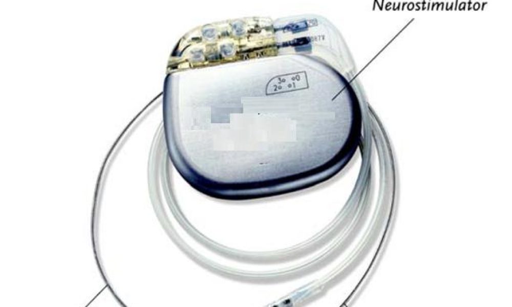 Implantable Neurostimulator Market SWOT Analysis by Key Players ...