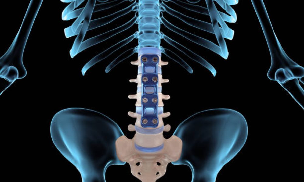 India Spinal Fusion Devices Market Report: Comprehensive Overview of ...