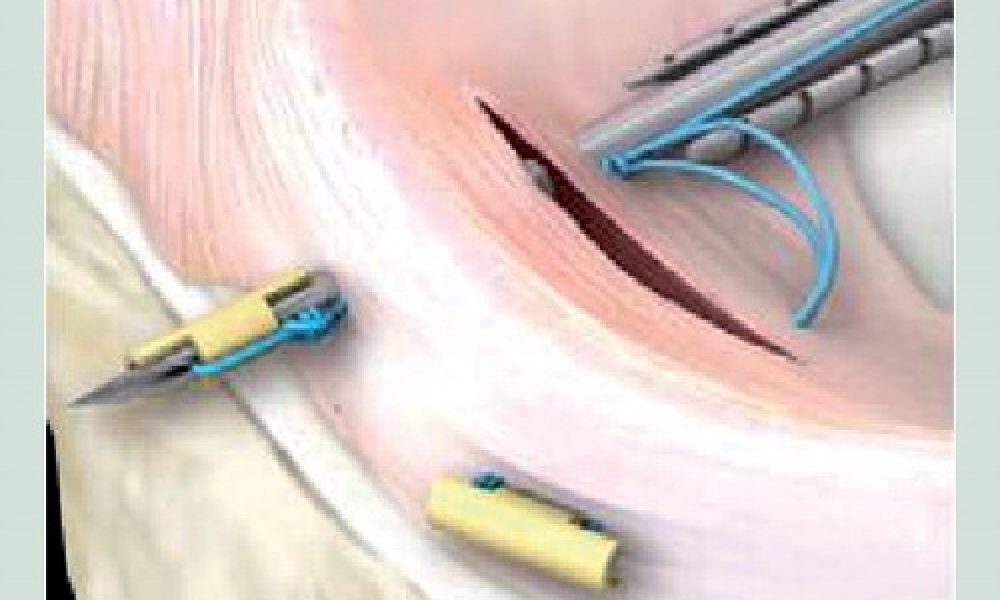 Meniscus Repair Device Market Hits New High | Major Giants Medtronic ...