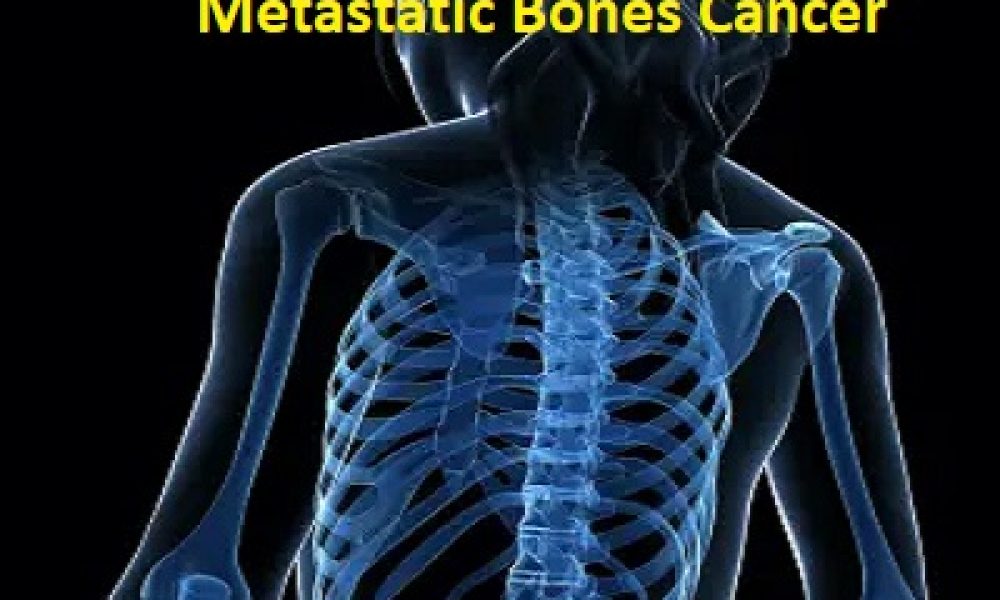 Metastatic Bone Disease Treatment Market Projected to Show Strong ...