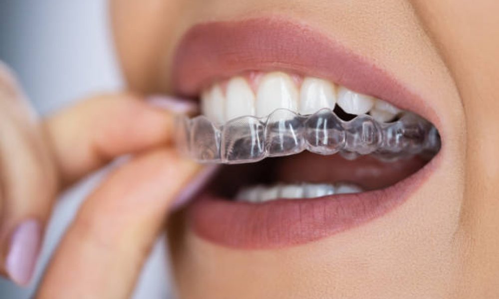Orthodontics Market Economic Forecast 2025: Tariff Impacts, Recession ...