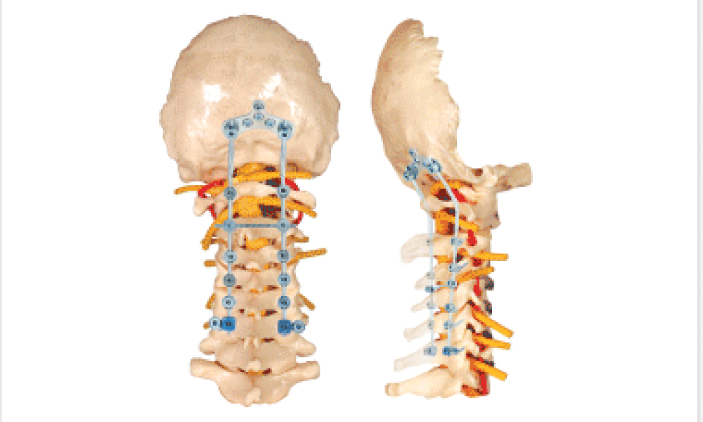 Posterior Occipital Cervical Thoracic Fixation System Market May Set a ...